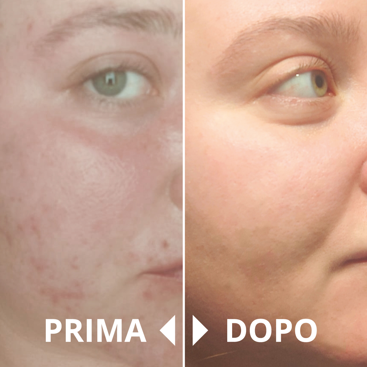Linea viso pelli impure: i prodotti per prendersi cura di pelle mista ...